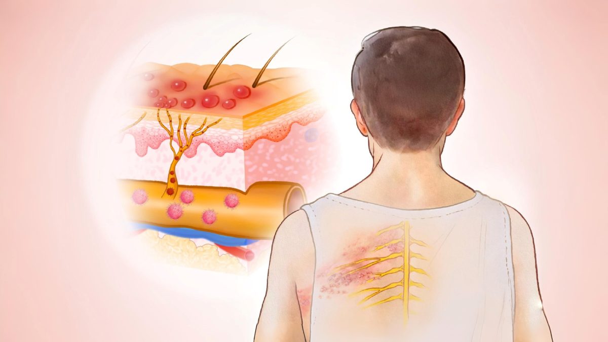 Le zona : causes, symptômes et traitements d’un virus qui peut ...