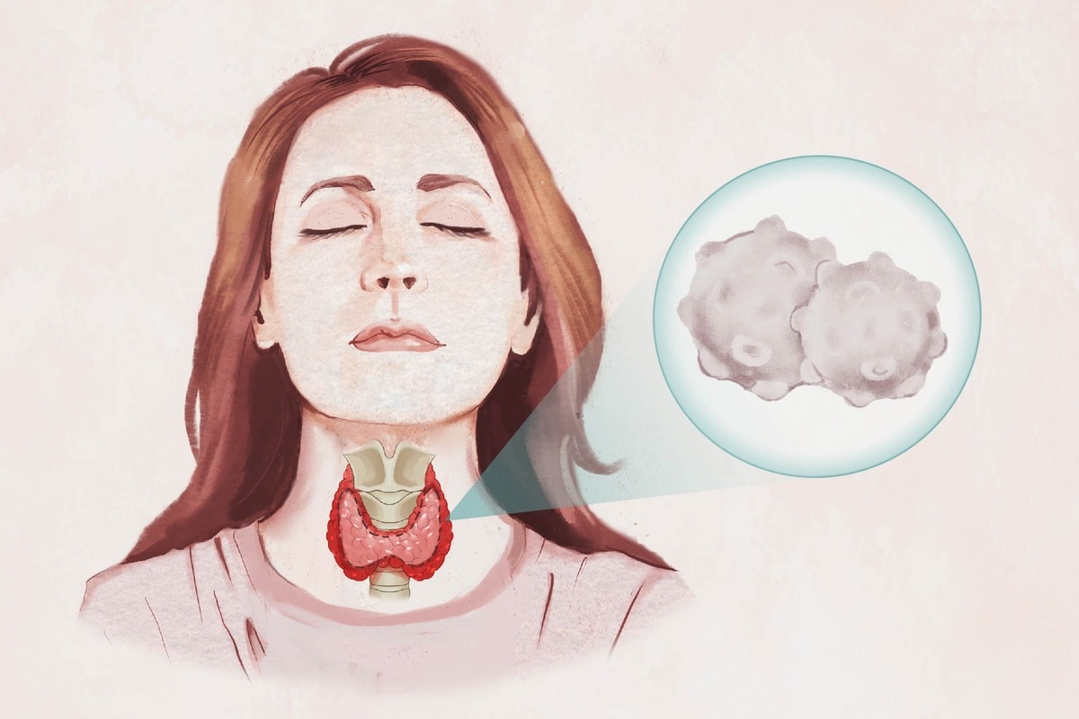Thyroïdite de Hashimoto : symptômes, causes, traitements et solutions ...